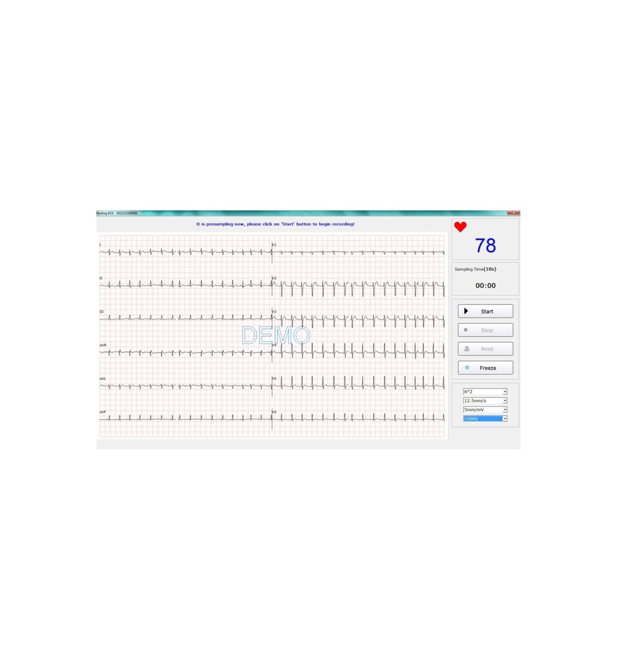 ECG PORTABLE PC NUMERIQUE SE-1010-DP12 - Diadice Médical